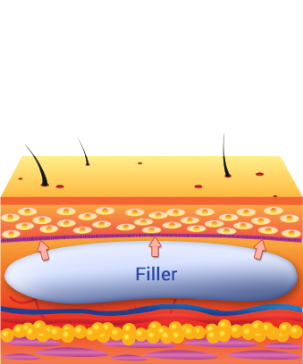 Fillers - Skinwell Dermatology - Dr. Ava Khosraviani, MD, FAAD